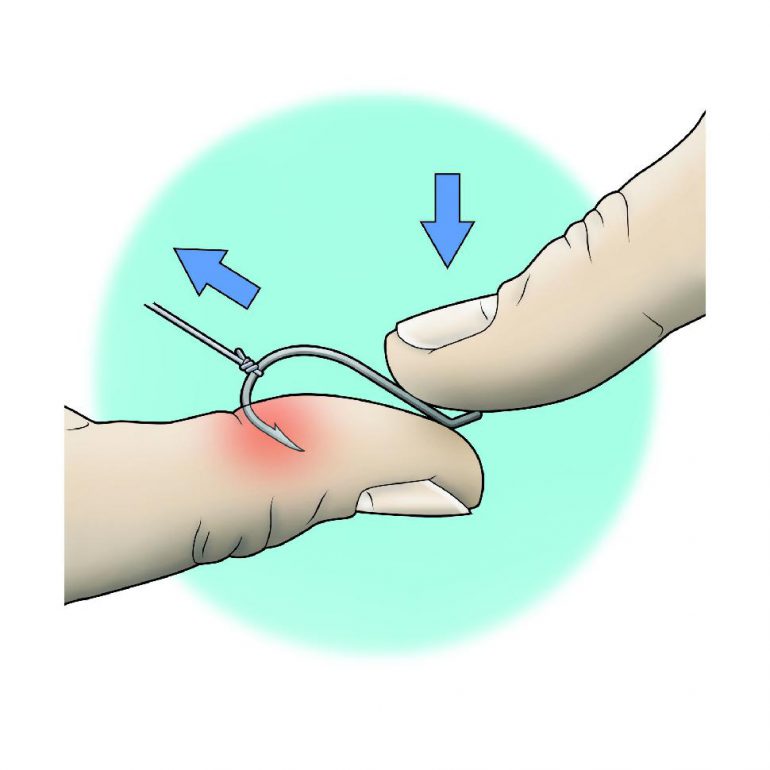 How to unhook yourself • Outdoor Canada